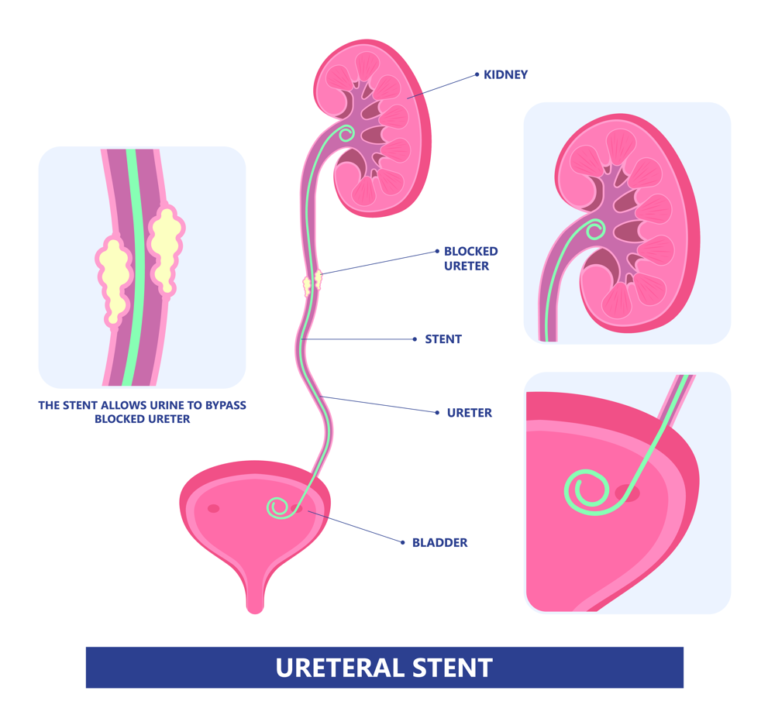 What is a Ureteral Stent and What to Expect